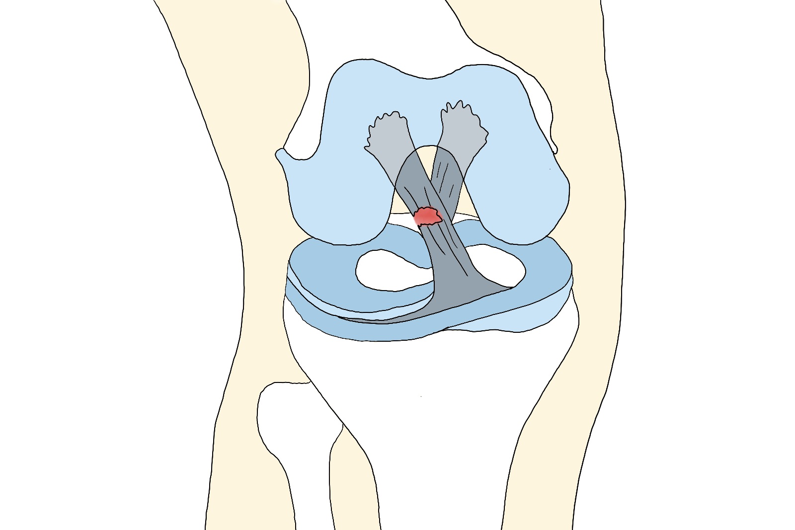 Kreuzbandruptur – Physiotherapie & Osteopathie Beger | Leipzig Böhlitz-Ehrenberg